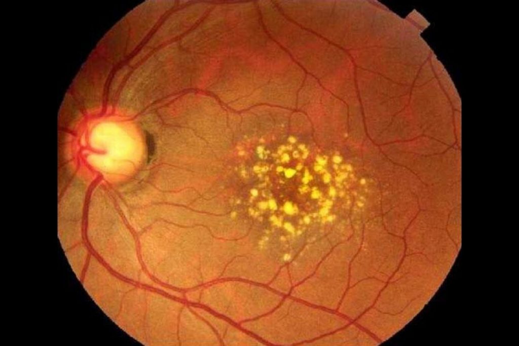 Age Related Macular Degeneration ( ARMD) – Vala Eye Centre : Best Eye ...