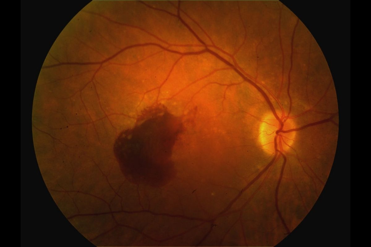 Age Related Macular Degeneration ( ARMD) – Vala Eye Centre